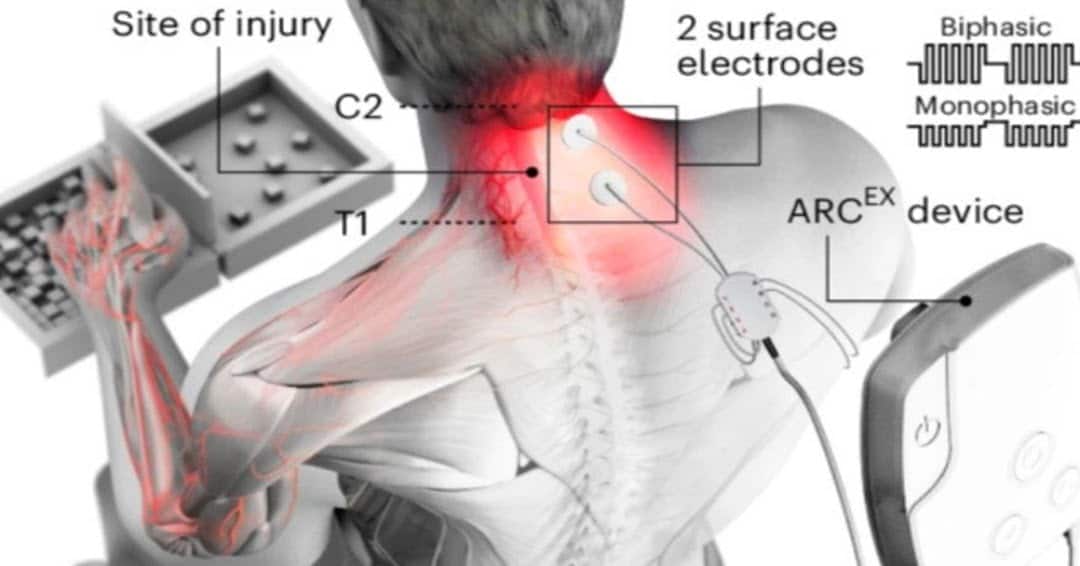 Neuroestimulación devuelve motricidad a pacientes tetrapléjicos ...