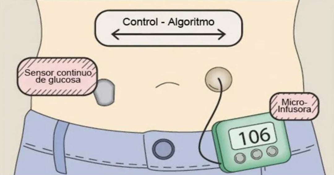 Un Páncreas Artificial Que Se Controla A Través Del Celular » Impacto ...